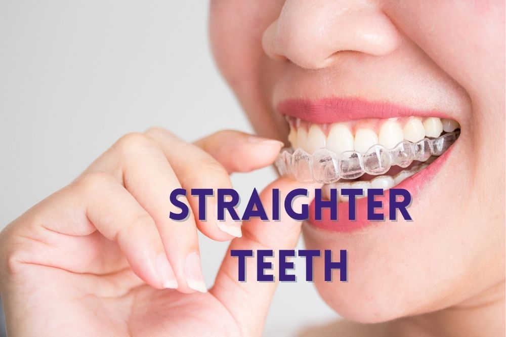 The Benefits of Invisalign: Straighter Teeth without the Hassle of ...